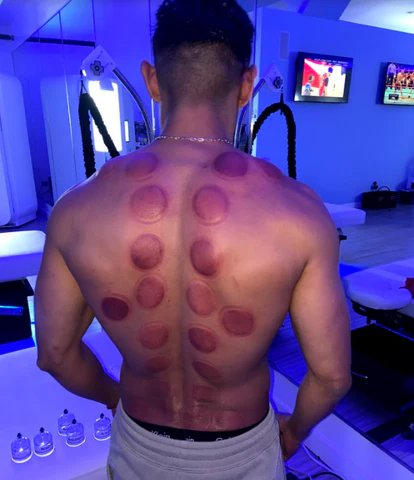 After Cupping Therapy Cupping Aftercare Instructions From